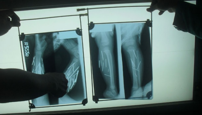 Dari mana Paku di Tubuh Safira? | tempo.co